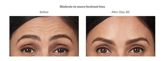 Botox | Tahoe Aesthetics by Candice | Lake Tahoe